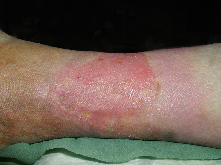 “Edemas slow down the healing of wounds” – Bauerfeind life